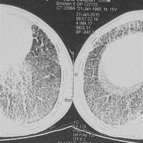 Chest X Ray Showing Bilateral Diffuse High Density Micronodular