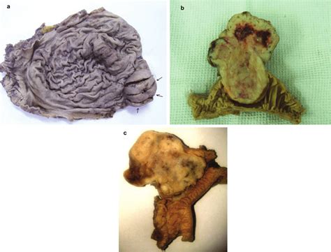 A Gross Of Gastric Gist Arrows B Gross Of Small Intestinal Gist C