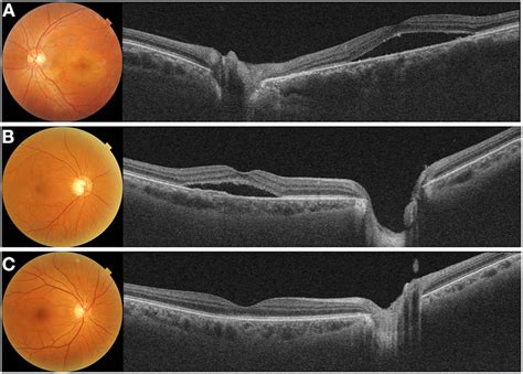 Representative Cases With A Acute Central Chorioretinopathy Csc Download Scientific