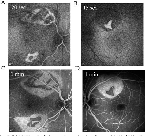 Hypertensive Choroidopathy Semantic Scholar