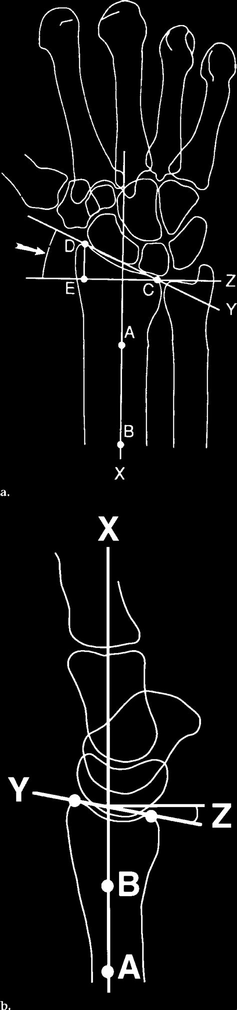 A Schematic Shows Method For Determination Of Radial Height Radial Download Scientific