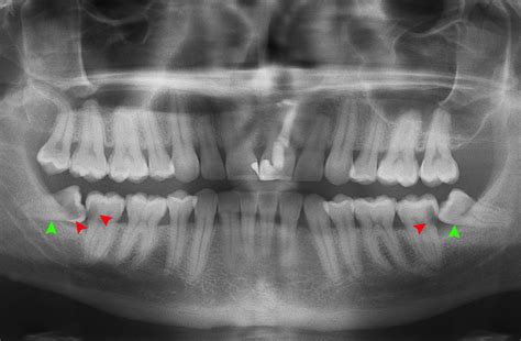 Impacted Teeth And Orthodontics Norwest Orthodontics