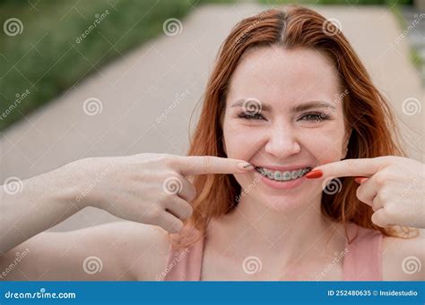 Young Red Haired Woman With Braces On Her Teeth Point To A Smile