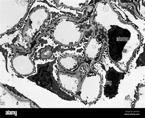 Glomerulus Transmission Electron Micrograph Tem Of A Section Through A Nephron In A Human
