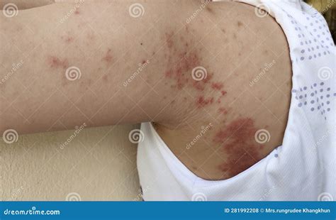 The Chronic Dermatitis Rash Hives Allergy And Peeling Skin Stock