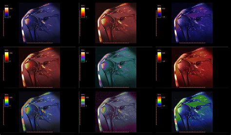 What Is A Shoulder Mri Arthrogram