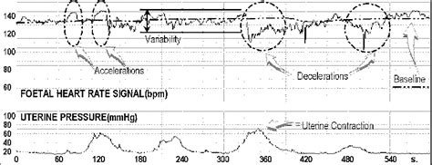 Figure 1 From Intelligent Analysis And Pattern Recognition In Cardiotocographic Signals Using A