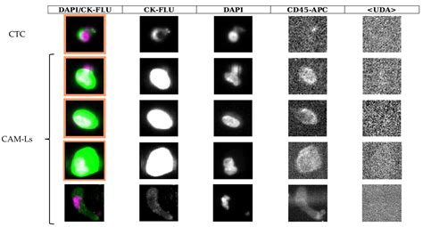 Ijms Free Full Text Circulating Cancer Associated Macrophage Like