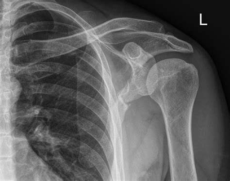 Shoulder Anatomy Evaluation And Investigations Shoulder Surgeon In Mumbai Dr Amyn Rajani