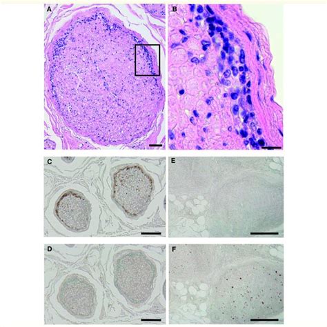 Nodular Sclerosing Pattern Of Hodgkins Lymphoma Download Scientific Diagram
