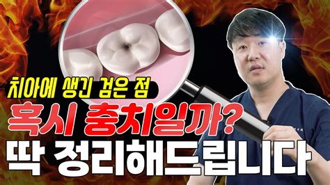 치아에 생긴 검은 점 충치일까 ⏰ 3분으로 완벽정리 ｜충치｜정지우식 Youtube