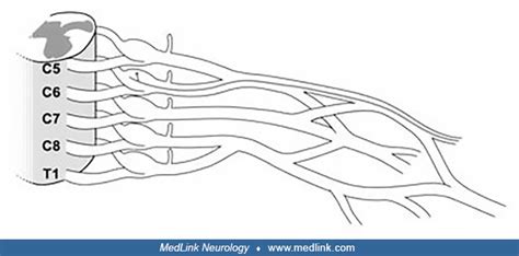 Neuralgic Amyotrophy Medlink Neurology