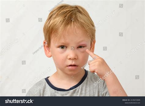 Стоковая фотография 2139272849 Portrait Boy Swollen Eye Insect Bite