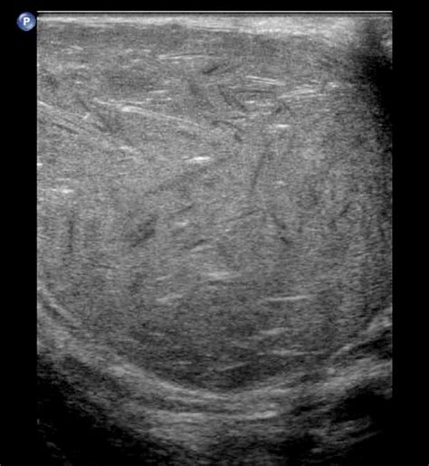 A Scrotal Ultrasonography Showed A 5 Cm×3 Cm×5 Cm Heterogeneous Download Scientific Diagram