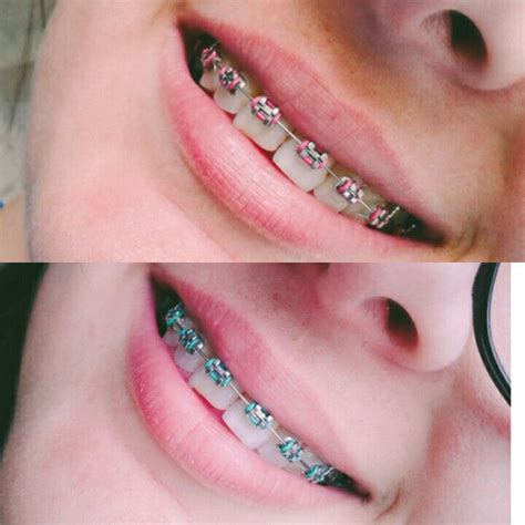 Braces Colors For Each Month At Dean Ransford Blog