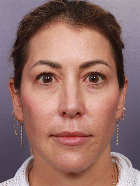 Eyelid Surgery Before And After 21776 Mps