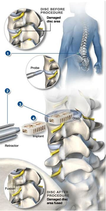 Xlif Lateral Lumbar Interbody Fusion The Southeastern Spine Institute