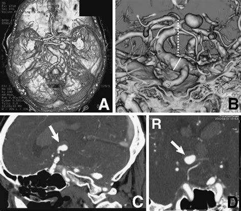 Figure 1 From Coil Embolization For A Ruptured Posterior Cerebral Artery Aneurysm With