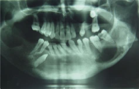 Panoramic X Ray Three Types Of Ondoto Genic Cysts Are Seen Download Scientific Diagram