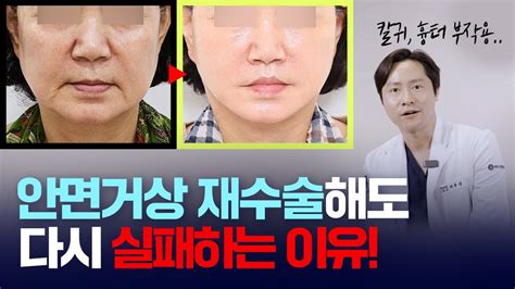 안면거상 부작용 재수술해도 다시 실패하는 이유 칼귀 흉터 실제 사례 보여드립니다 Youtube