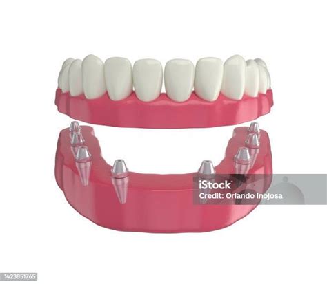 치과 보철물 8 개의 의치 임플란트 하부 아치 3d 렌더링 치아 임플란트에 대한 스톡 사진 및 기타 이미지 치아 임플란트 건강관리와 의술 건강한 생활방식 Istock