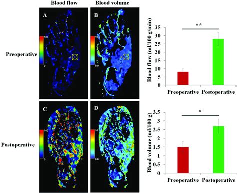 Computed Tomography Perfusion Maps Displaying Blood Flow And Volume In Download Scientific