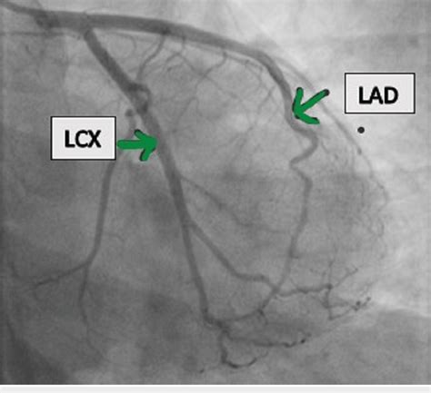 AP Caudal View Of Normal LAD AP Anteroposterior LAD Left Anterior Download Scientific