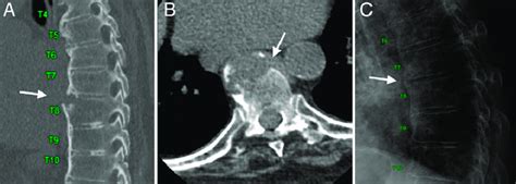 A Ct Scan Of The Thoracic Spine Without Iv Contrast Sagittal View Download Scientific