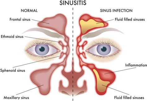 Sinusitis Primary Care Clinics In Office Practice