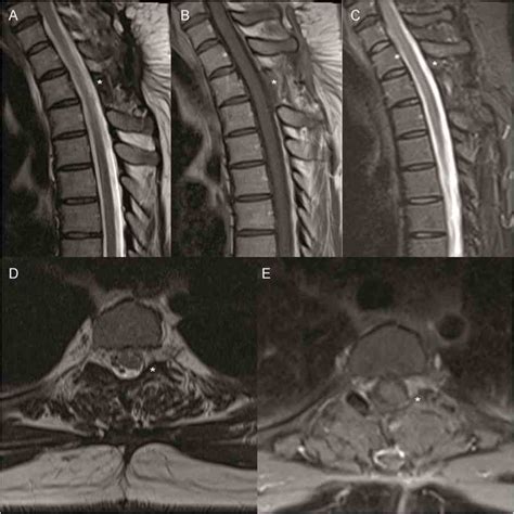 T2 Weighted A D And Stir C Images Show A Hyperintense Lesion With