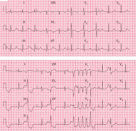 Ecg Case 147 Digoxin Effect With Possible Digoxin Toxicity Manual Of Medicine