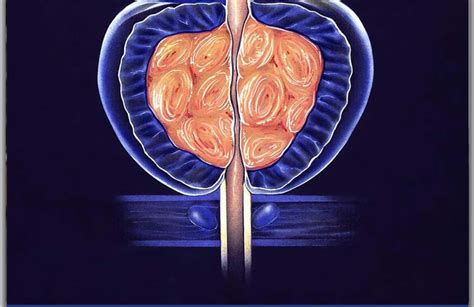 Laser Prostate Surgery Prof Dr Mustafa Sofikerim