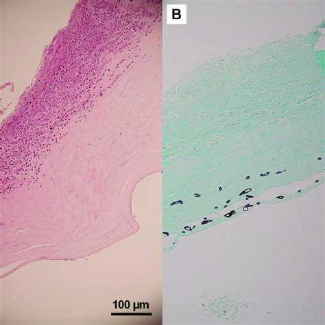 Histopathology Of Pythium Keratitis In Globe Removal Case Case Download Scientific
