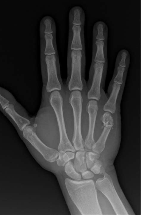Nx Nail Fixation Of Fifth Metacarpal Fracture Involving Distal