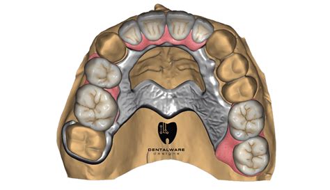 Removable Partial Framework Dentalware Designs