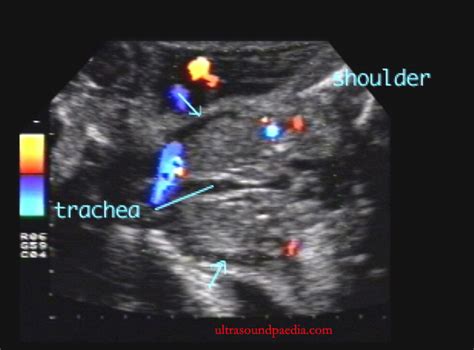 Goitre ULTRASOUNDPAEDIA