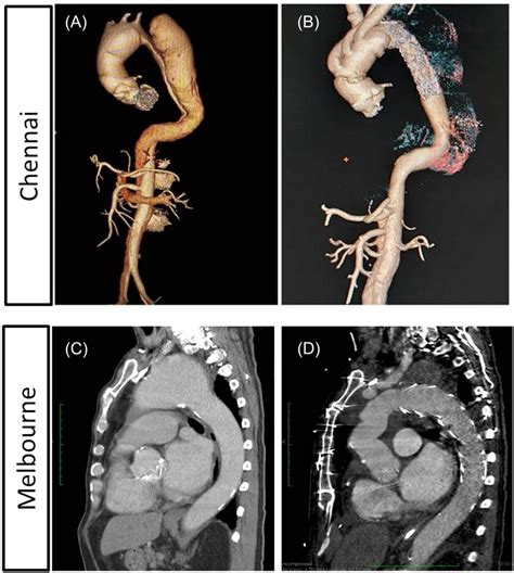 A Preoperative Ct Aortogram Showing The Ascending And Aortic Arch