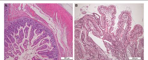Figure 1 From A Rare Cause Of Gastrointestinal Bleeding In Adults Ileal Duplication With
