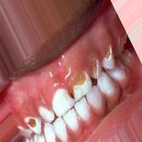 Tooth Detection Object Detection Dataset V2 2024 01 16 248pm By Chio