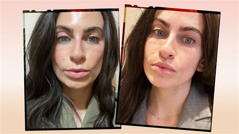 How I Really Feel About My Lip Lift Surgery — See My Before And After