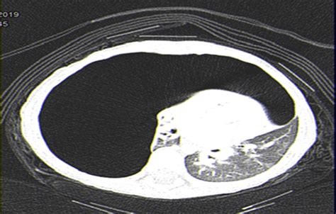 Right Sided Hyperlucency Herniating To The Left And Tracheal Deviation