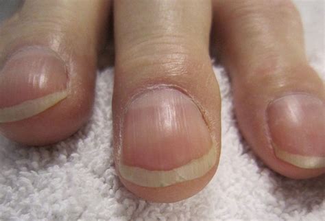 Fingernail And Toenail Abnormalities Nail The Diagnosis