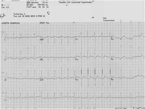 Ekg Of A Patient In Whom Computer Generated Readings Failed To Identify