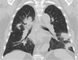 Neumonía Organizada Radiología