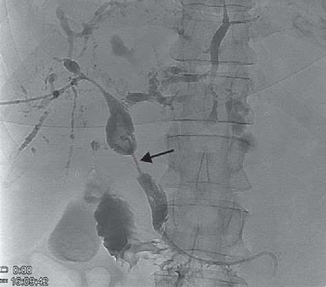 Figure 1 From Primary Sclerosing Cholangitis And Cholangiocarcinoma