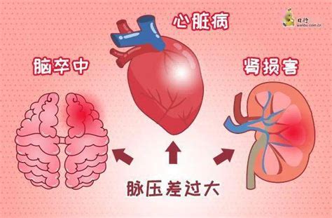 高血压管理六高压减去低压差值太大这可不是好事 脉压