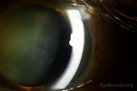 Pseudoexfoliation Of Lens Capsule Icd 10 At Norma Shanks Blog