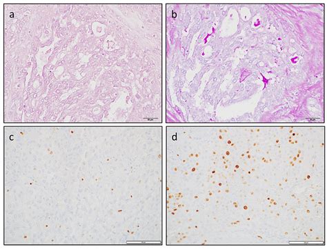 Special Stains And Ki 67 Labeling Index A Mucicarmine Staining