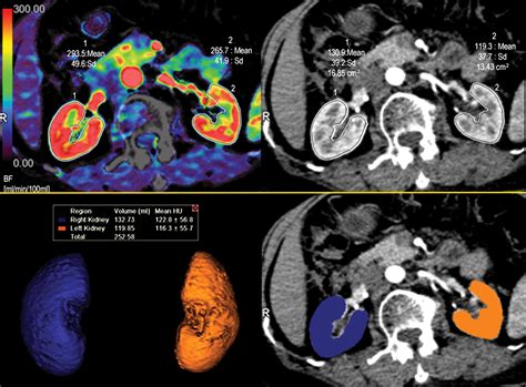 A Simplified Whole Organ Ct Perfusion Technique With Biphasic Acquisition Preliminary