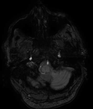 File Glioblastoma IDH Wildtype Radiopaedia Axial Png NC Commons
